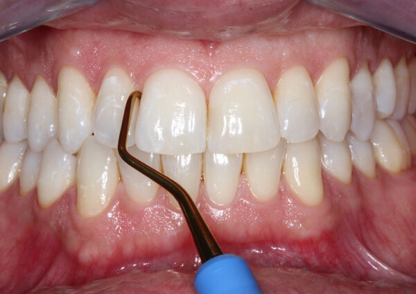 ProThin™ Periodontal Instruments - American Eagle Instruments